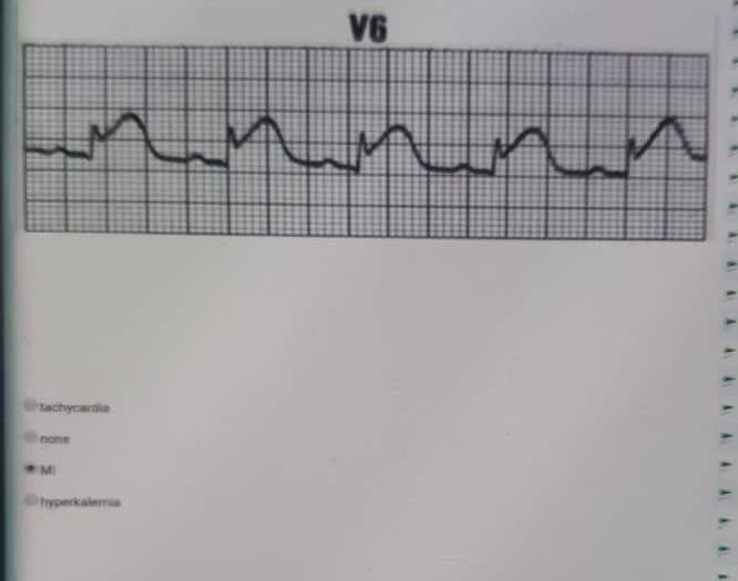 Solved V6 nnnnn Tachycard Type A mother with a negative Rh | Chegg.com