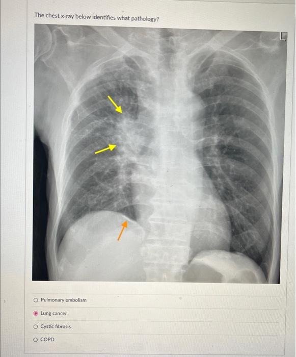 Pulmonary Embolism Chest X Ray