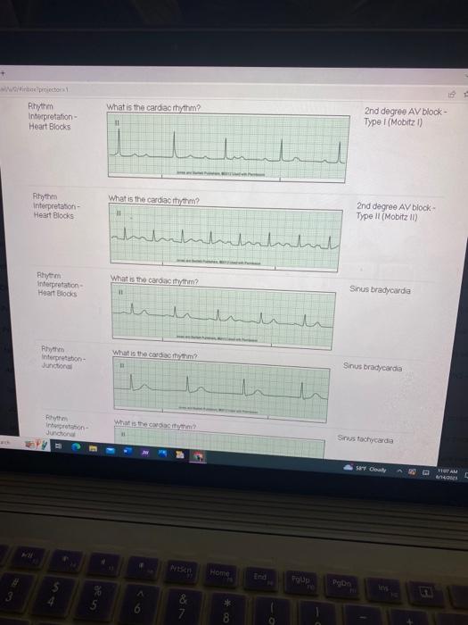 Solved Riytim Interpretation = Heart Biocks Ahythm | Chegg.com