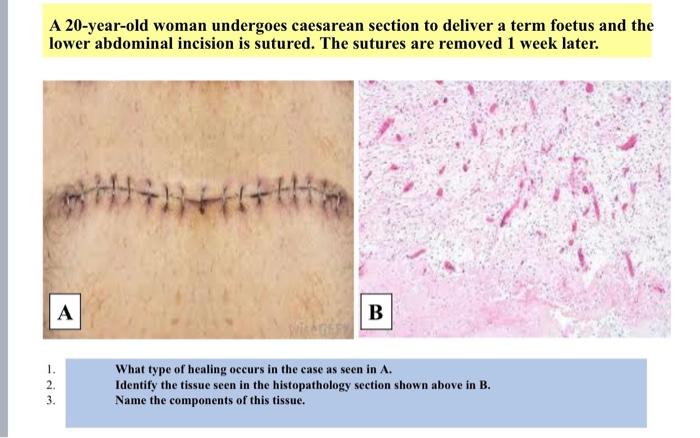 Solved What type of healing occurs in the case as seen in | Chegg.com