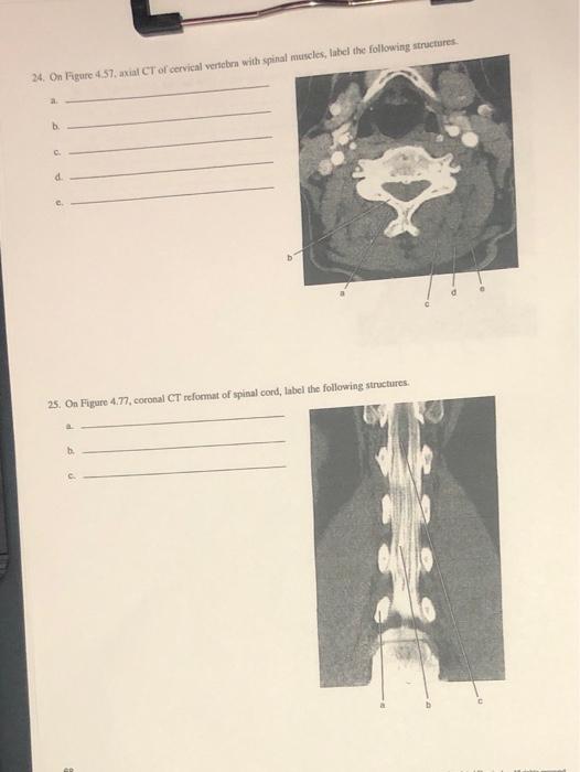 Solved 24. On Figure 457, axial CT of cervical vertebra with | Chegg.com