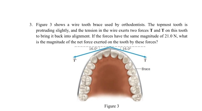 Solved Figure 3 ﻿shows a wire tooth brace used by | Chegg.com