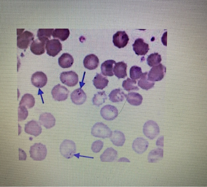 IDA ACI Thalassemia Sideroblastic anemia Porphyria | Chegg.com