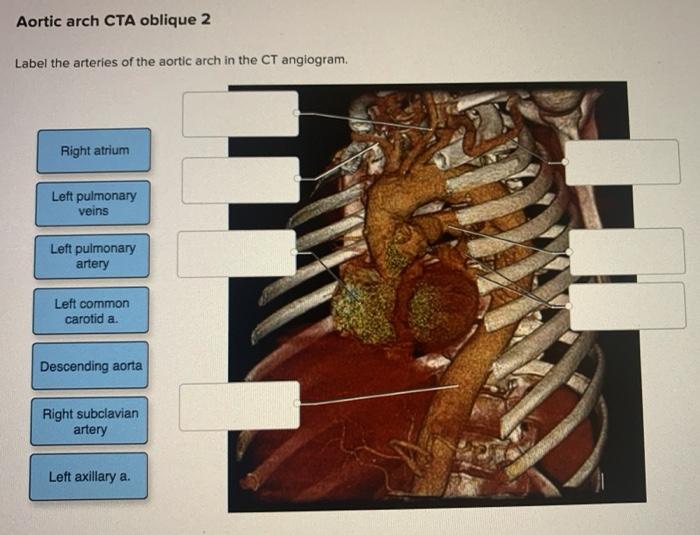 Solved Label the arteries of the aortic arch in the CT | Chegg.com
