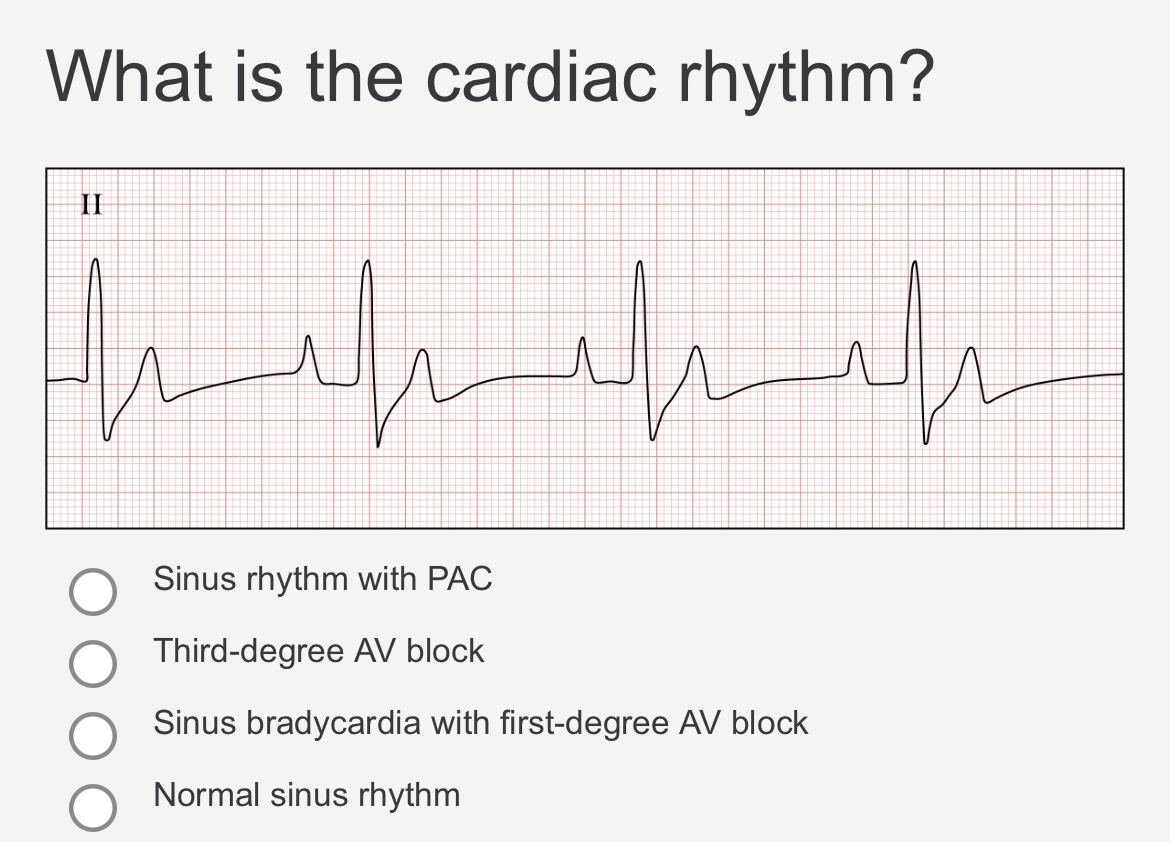 Solved What is the Cardiac Rhythm shown in the EKG strip? | Chegg.com