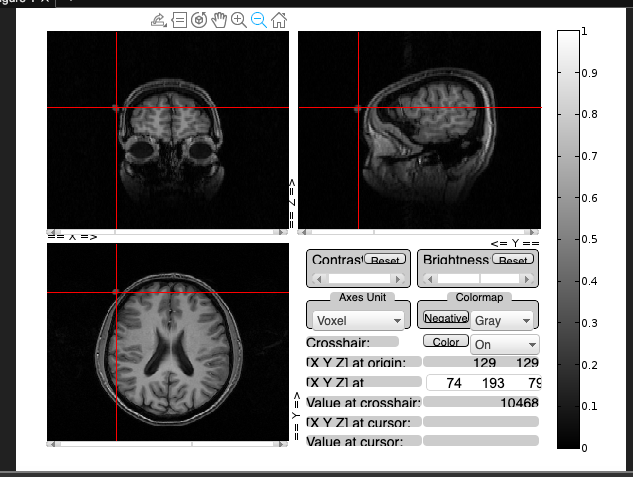 Solved On this MRI, its centered on a grey blob outside the | Chegg.com