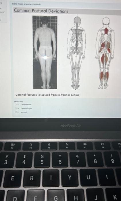 Common Postural Deviations Coronal features (assessed | Chegg.com
