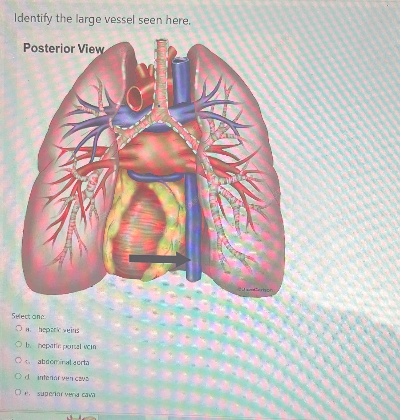 Solved Identify the large vessel seen here.Select one:a. | Chegg.com