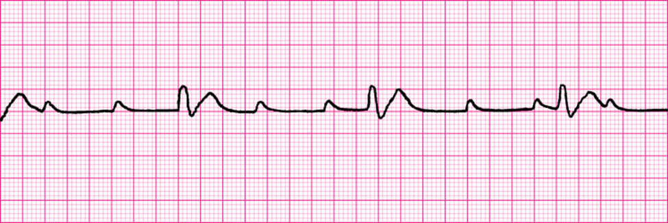 Solved What is the rhythm? ﻿Sinus Rhythm with 3rd Degree | Chegg.com