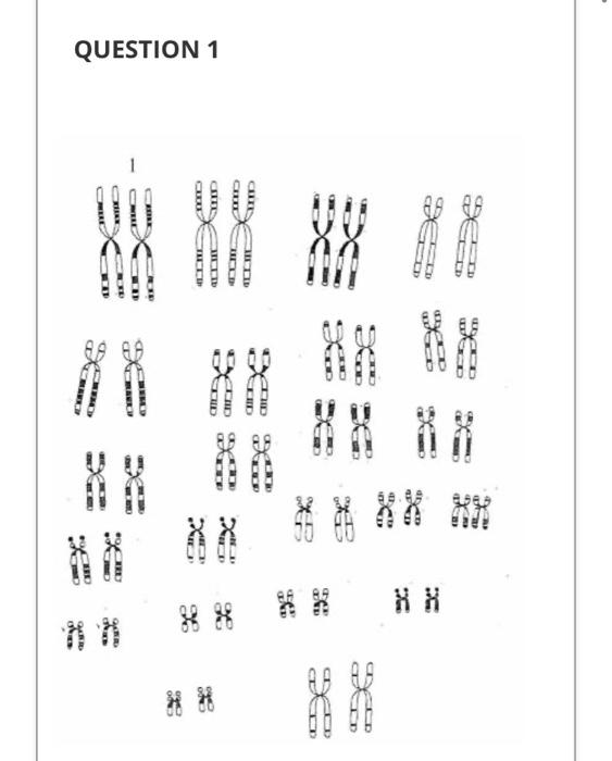 Solved Downs - Trisomy Downs - Translocation Turners | Chegg.com