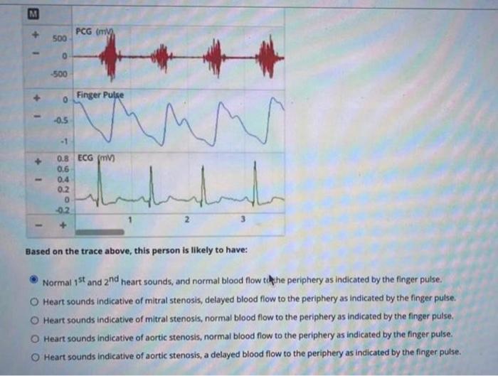Solved PCG (my + 500 + - 0 -500 + 0 Finger Pulse o - -0.5 -1 | Chegg.com
