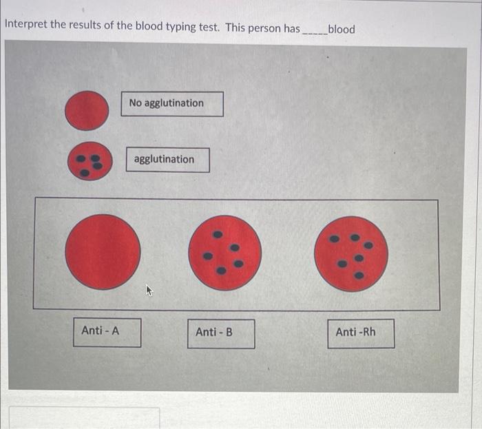Solved Interpret the results of the blood typing test. This | Chegg.com
