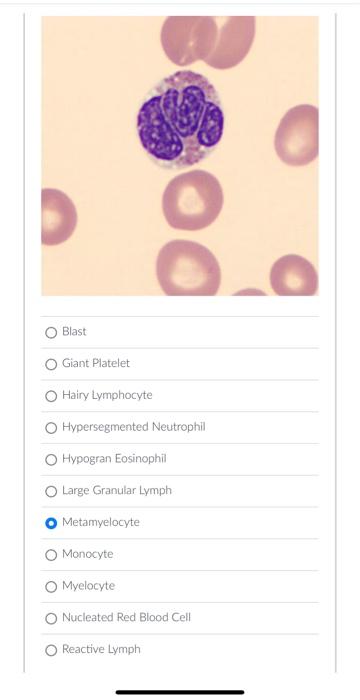 Solved Blast. Giant Platelet Hairy Lymphocyte Hypersegmented | Chegg.com