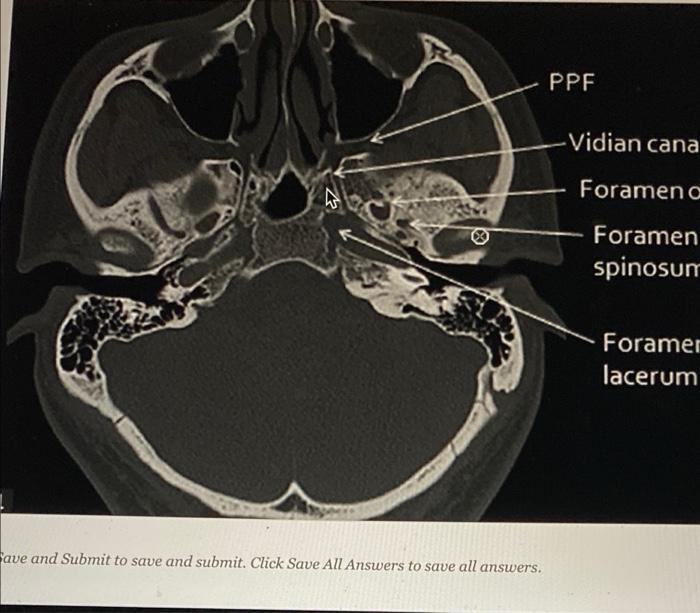 Solved PPF -Vidian cana 7 Foramena Foramen spinosur Foramer | Chegg.com