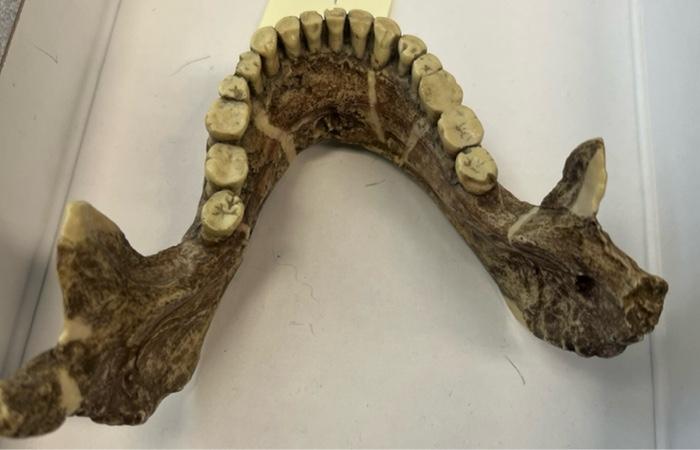Solved Under which tooth is the mental foramen on this | Chegg.com