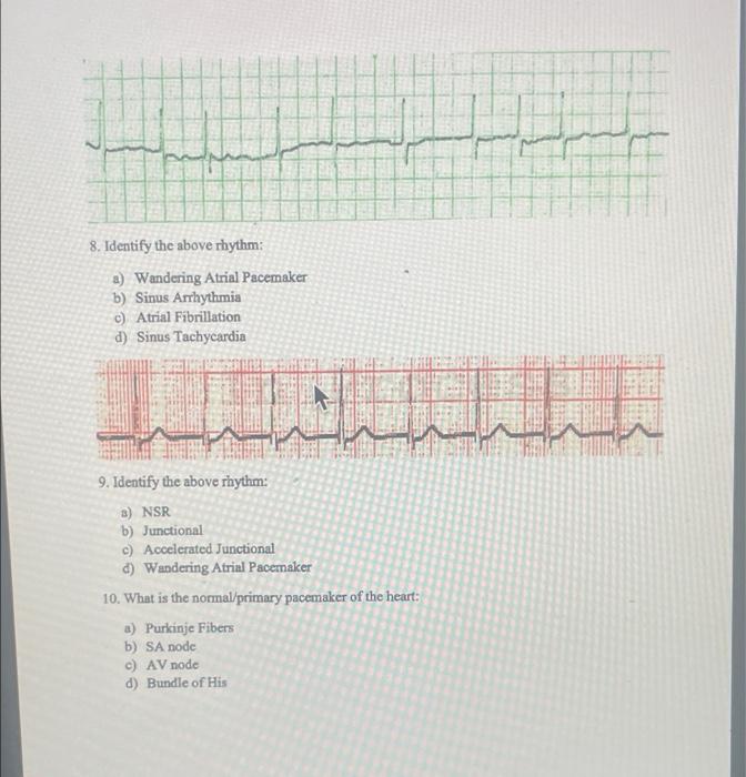 Wandering Atrial Pacemaker Rhythm Strip