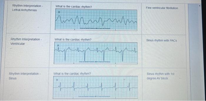 Rhuthm Intermonatian Rhythm Inte Lethal Arrhy Rhythm | Chegg.com