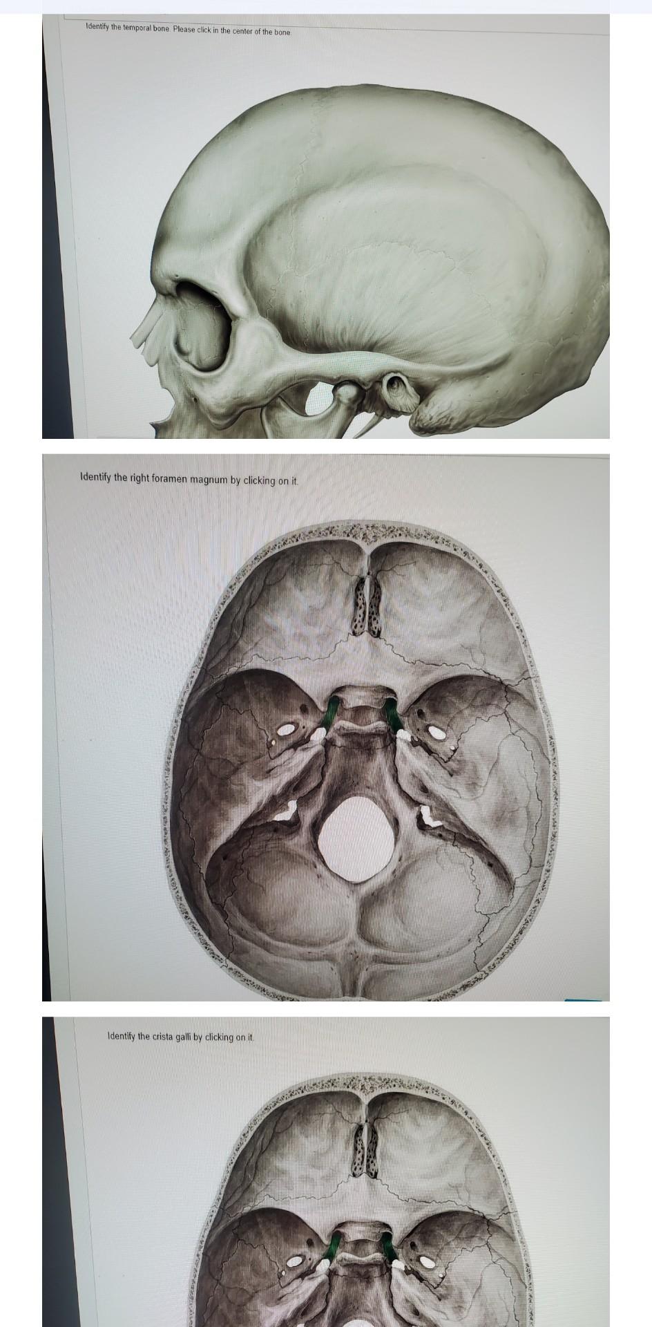 Solved Identify the temporal bone. Please click in the | Chegg.com