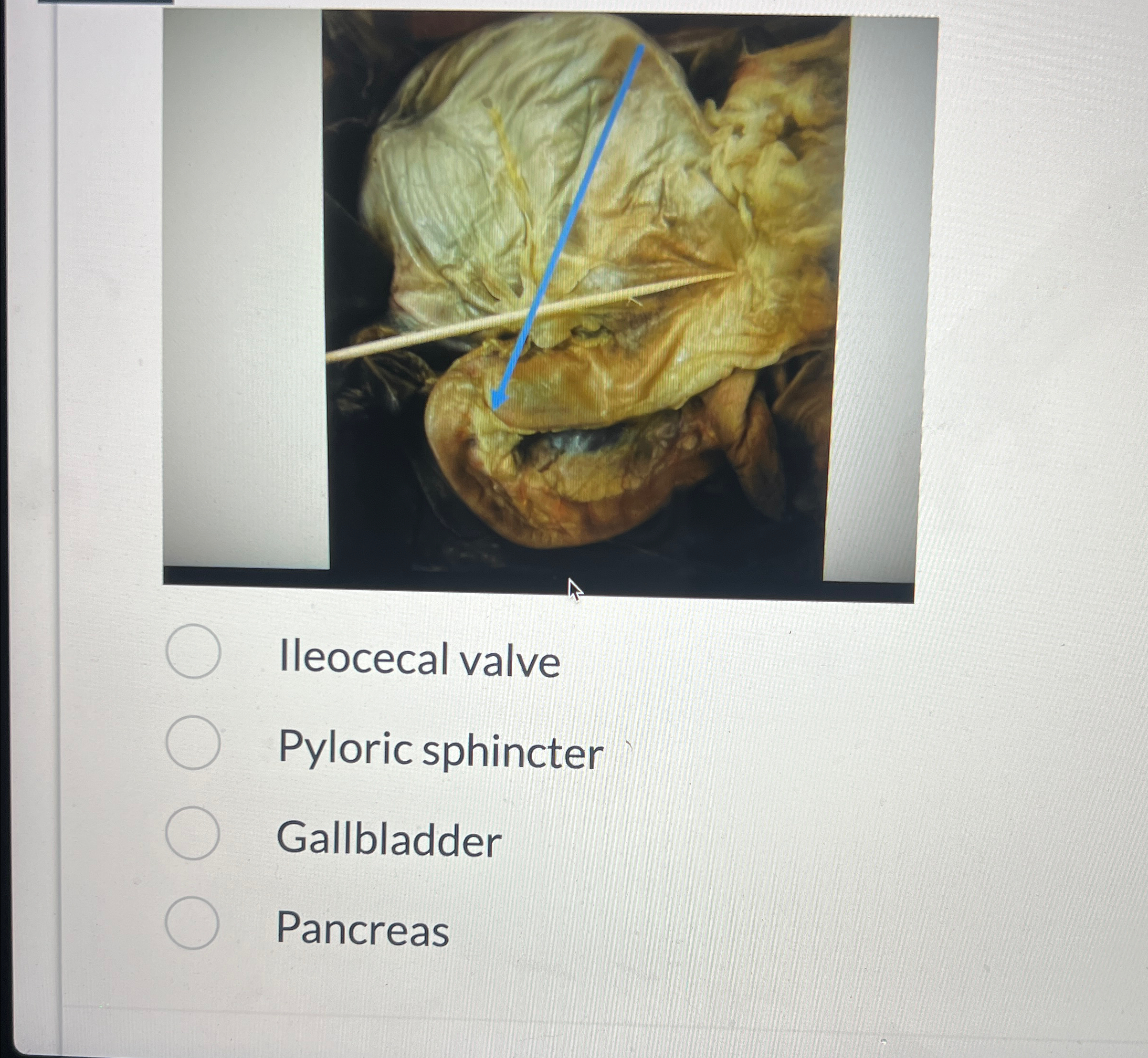 [Solved]: Ileocecal valve Pyloric sphincter Gallbladder Panc