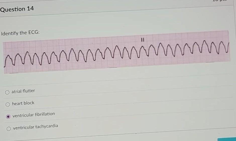 Solved Identify the ECG: heart block ventricular tachycardia | Chegg.com
