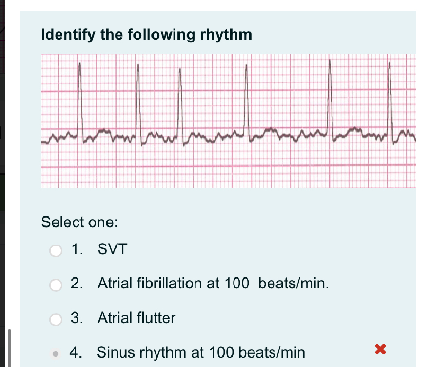 Solved Identify the following rhythmSelect one:SVTAtrial | Chegg.com