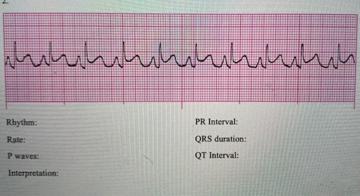 Solved Алллллллл Rhythm: : PR Interval: Rate: QRS duration: | Chegg.com
