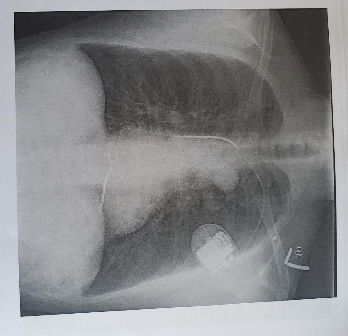 Solved 9- ﻿interpret this CXR and explain reasoning behind | Chegg.com
