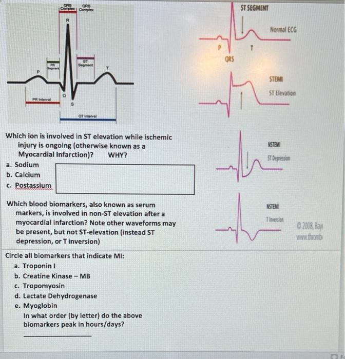ORS Com Complex ST SEGMENT Normal ECG ORS STEMI ST | Chegg.com