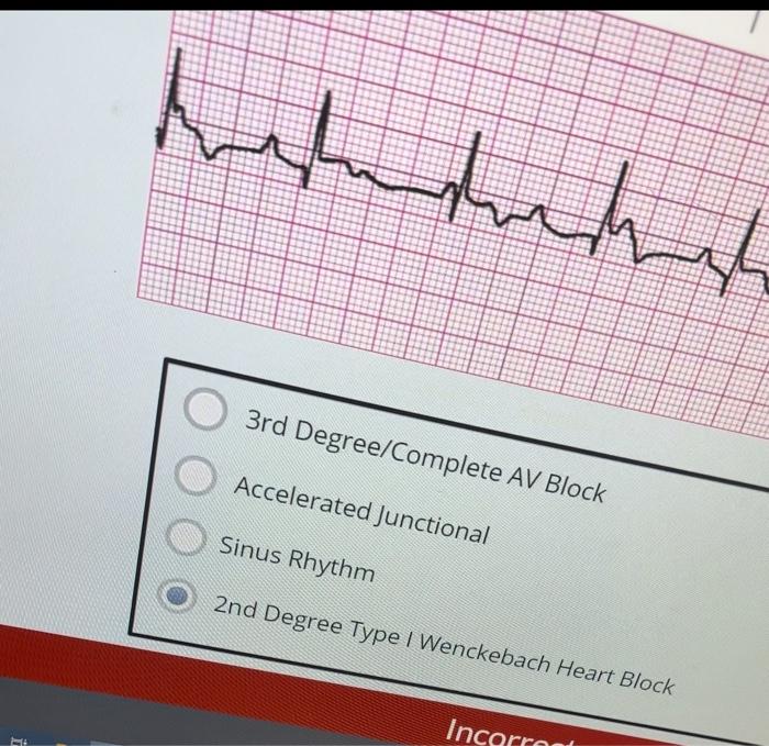 Sinus Arrhythmia Sinus Rhythm with PVC Sinus Rhythm | Chegg.com