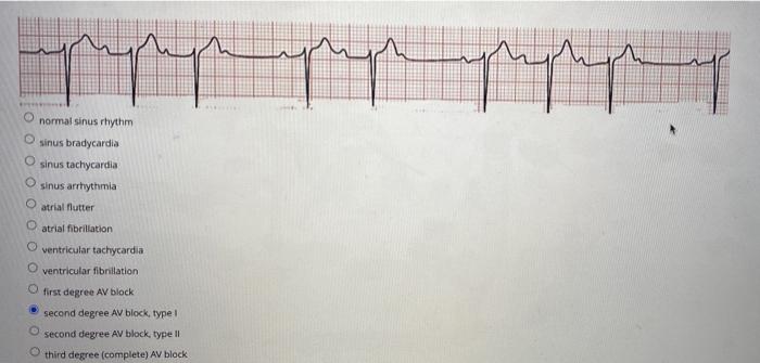 Solved normal sinus rhythm sinus bradycardia sinus | Chegg.com