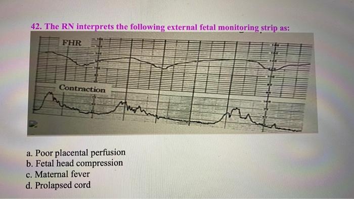Solved 42. The RN interprets the following external fetal | Chegg.com