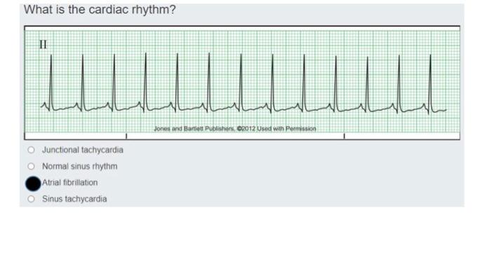 What is the cardiac rhythm? Junctional tachycardia | Chegg.com