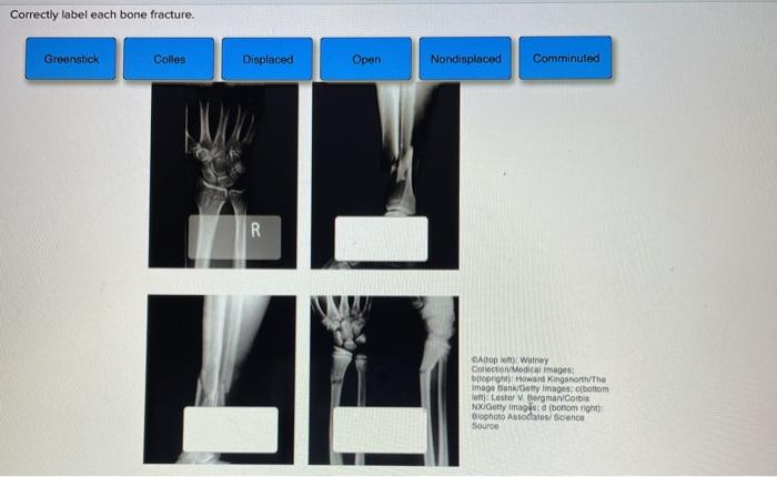 Solved Correctly label each bone fracture. Greenstick Colles | Chegg.com