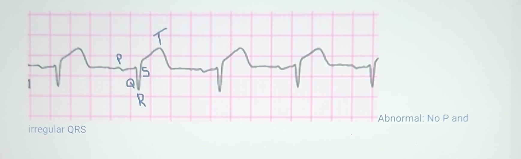 Solved irregular QRS Abnormal: No P and | Chegg.com