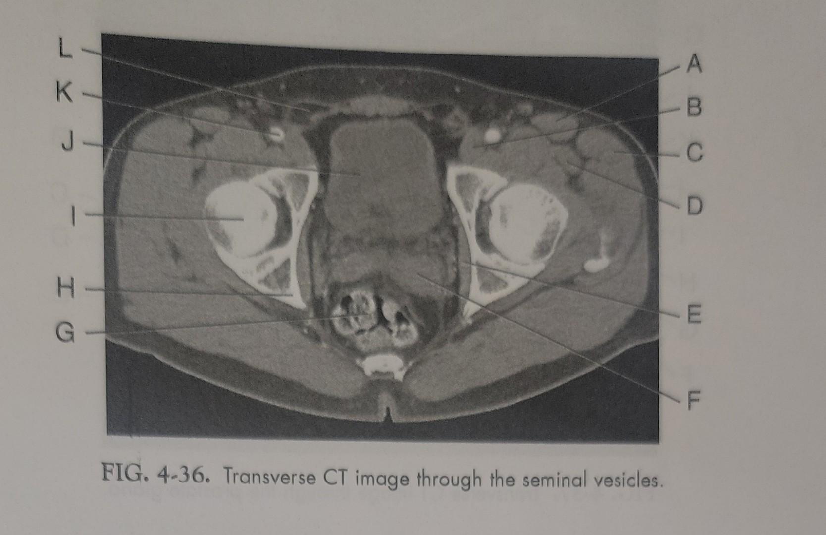 Solved FIG. 4-36. Transverse CT image through the seminal | Chegg.com
