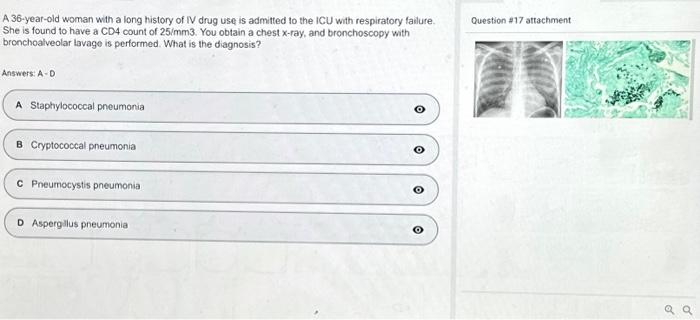 A 36-year-old woman with a long history of IV drug | Chegg.com