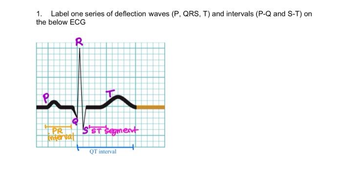 Solved 1. Label one series of deflection waves (P, QRS, T) | Chegg.com