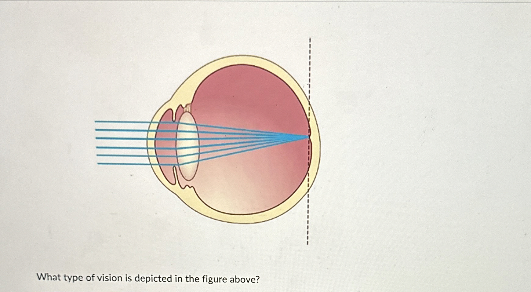 Solved What type of vision is depicted in the figure above? | Chegg.com
