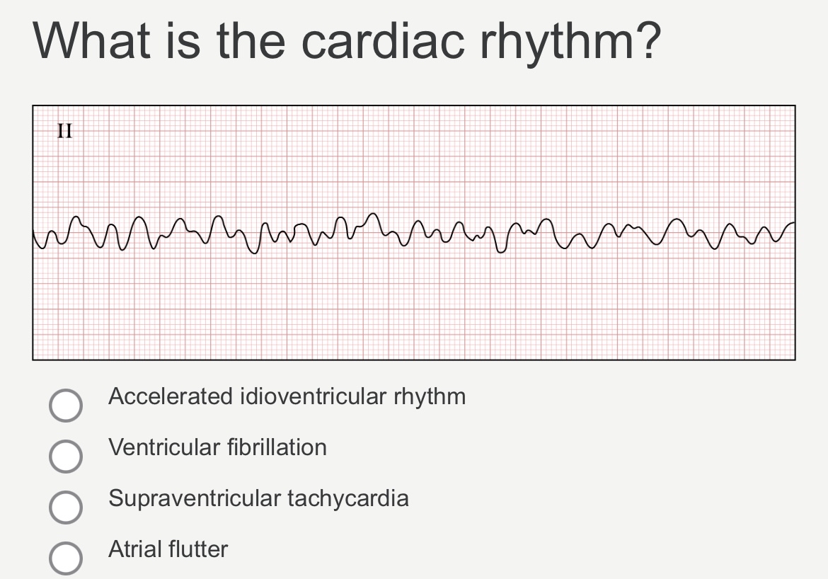 Solved What is the cardiac rhythm shown in the EKG strip? | Chegg.com