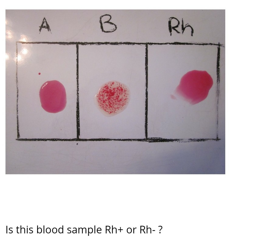 Solved А Rh Is this blood sample Rh+ or Rh- ? | Chegg.com