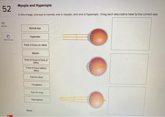 Solved Myopia and Hyperopia 52 In this image, one eye is | Chegg.com