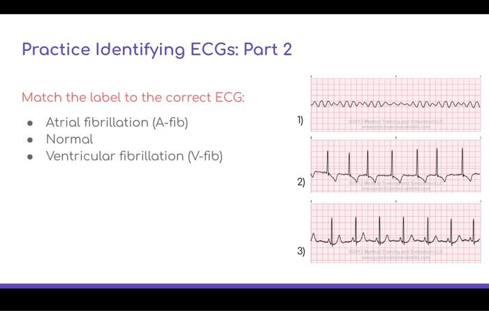 Solved Practice Identifying ECGs: Part 3 Match the label to | Chegg.com