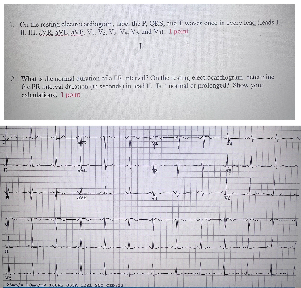 Solved On the resting electrocardiogram, label the P,QRS, | Chegg.com
