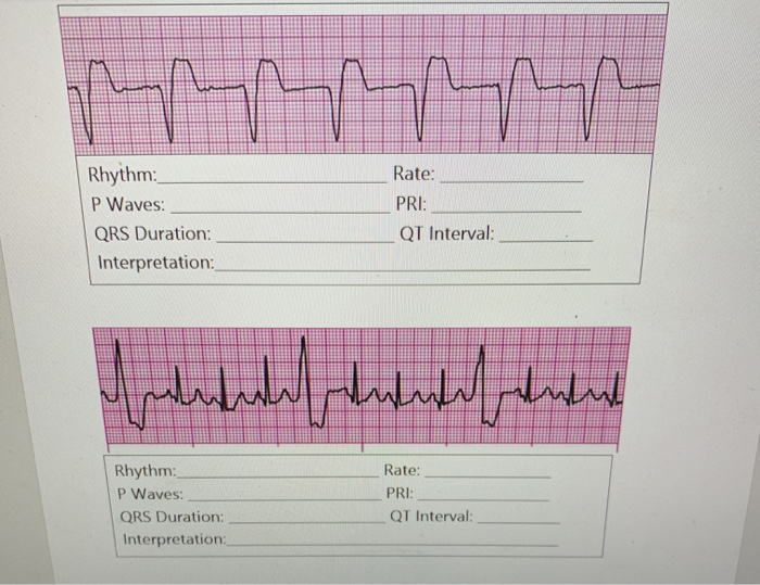 Solved My Rate: Rhythm: P Waves: QRS Duration: | Chegg.com