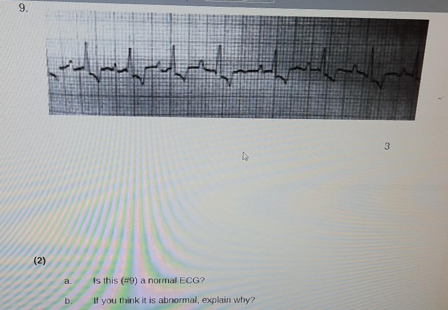 Solved 1.(5) On the ECG pictured below, match the following | Chegg.com