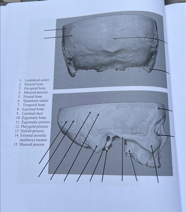1. Lambdoid suture 2. Parietal bone 3. Occipital bone | Chegg.com