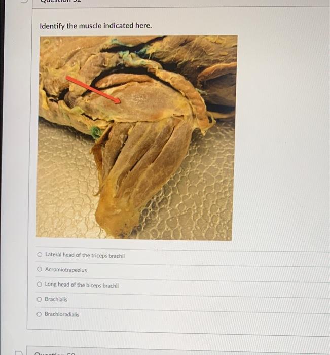 Solved Identify the muscle indicated here. Lateral head of | Chegg.com