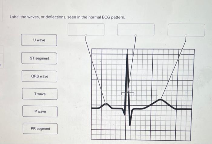 Solved Label the waves, or deflections, seen in the normal | Chegg.com