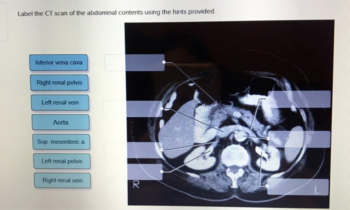 Solved Label the CT scan of the abdominal contents using the | Chegg.com