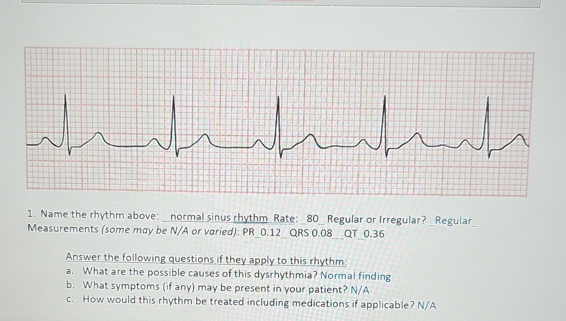 Solved 1. Name the rhythm above: normal sinus rhythm Rate: | Chegg.com